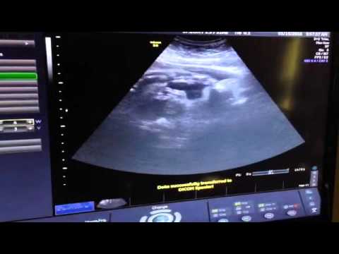 31 weeks ultrasound, my baby boy Bruno - YouTube
