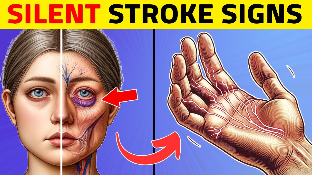 10 Silent Stroke Signs You Shouldn't Ignore! - YouTube