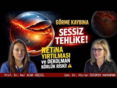 Retina Yırtılması ve Dekolman Olunca Neler Oluyor? #retina #göz #podcast
