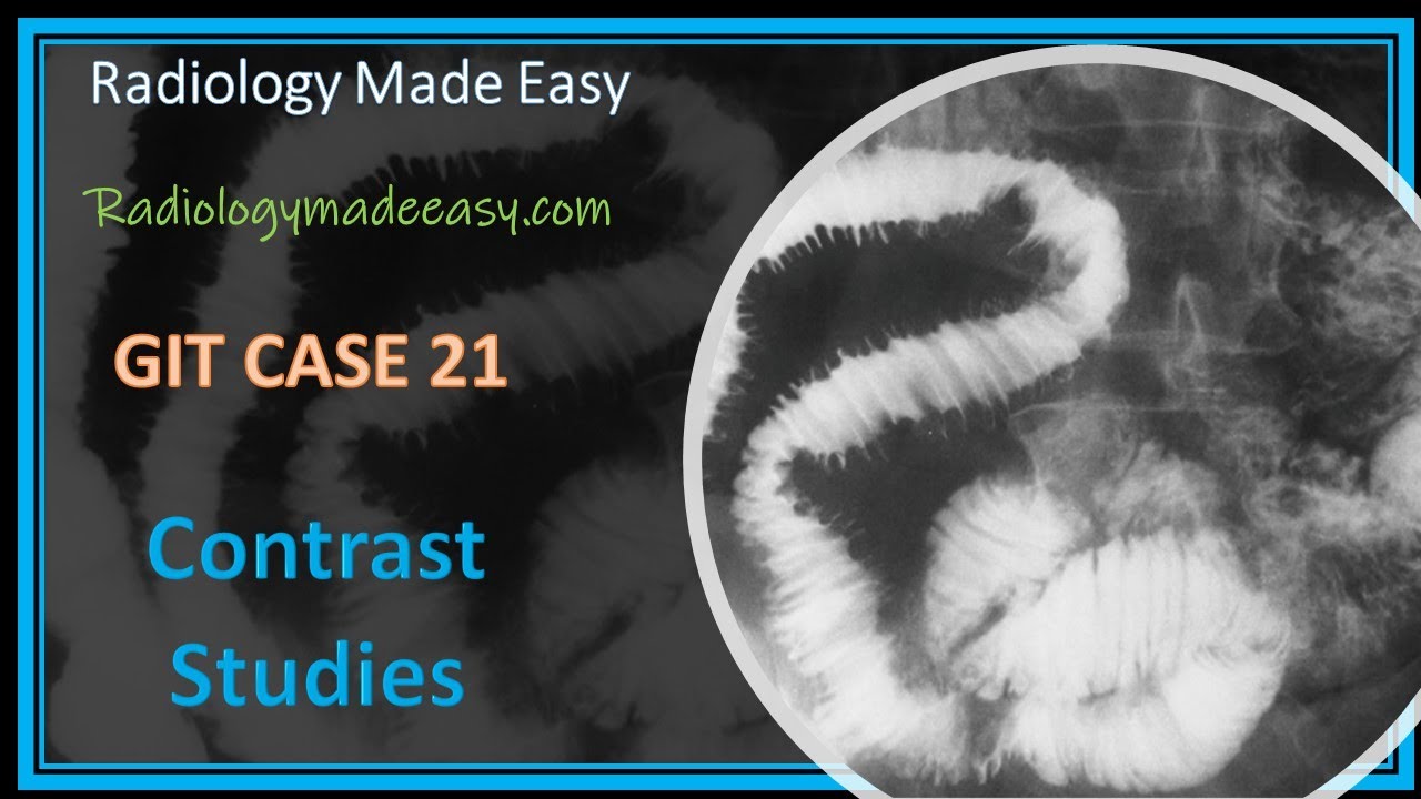 FRCR Radiology GIT Contrast cases 21: 42 yrs old female patient presented with bloating in ...