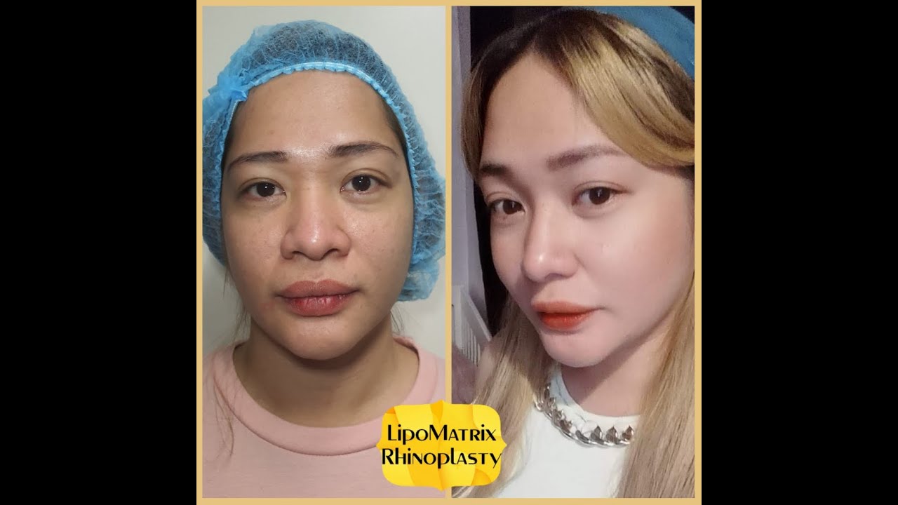 LipoMatrix Rhinoplasty by Dr. Claudine Roura - Frequently asked ...