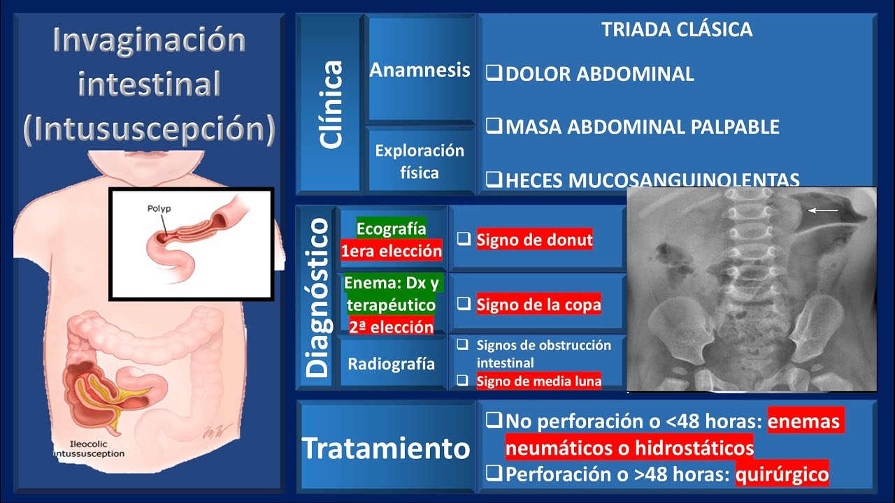 Invaginación intestinal: causas, dx y tratamiento. Para el #enarm - YouTube