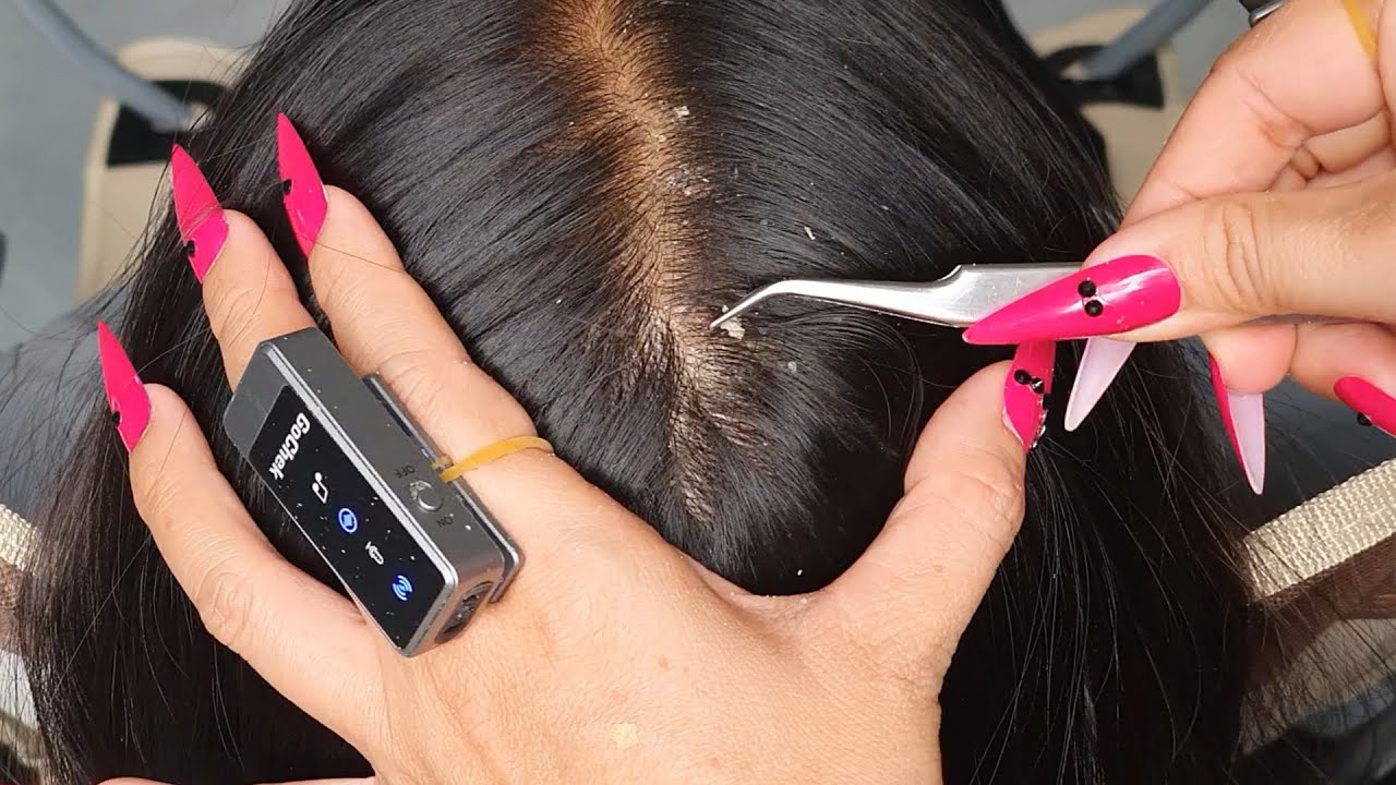 Scalp Scratch Therapy You’ll Feel Through the Screen 🎧 | ASMR Flake ...