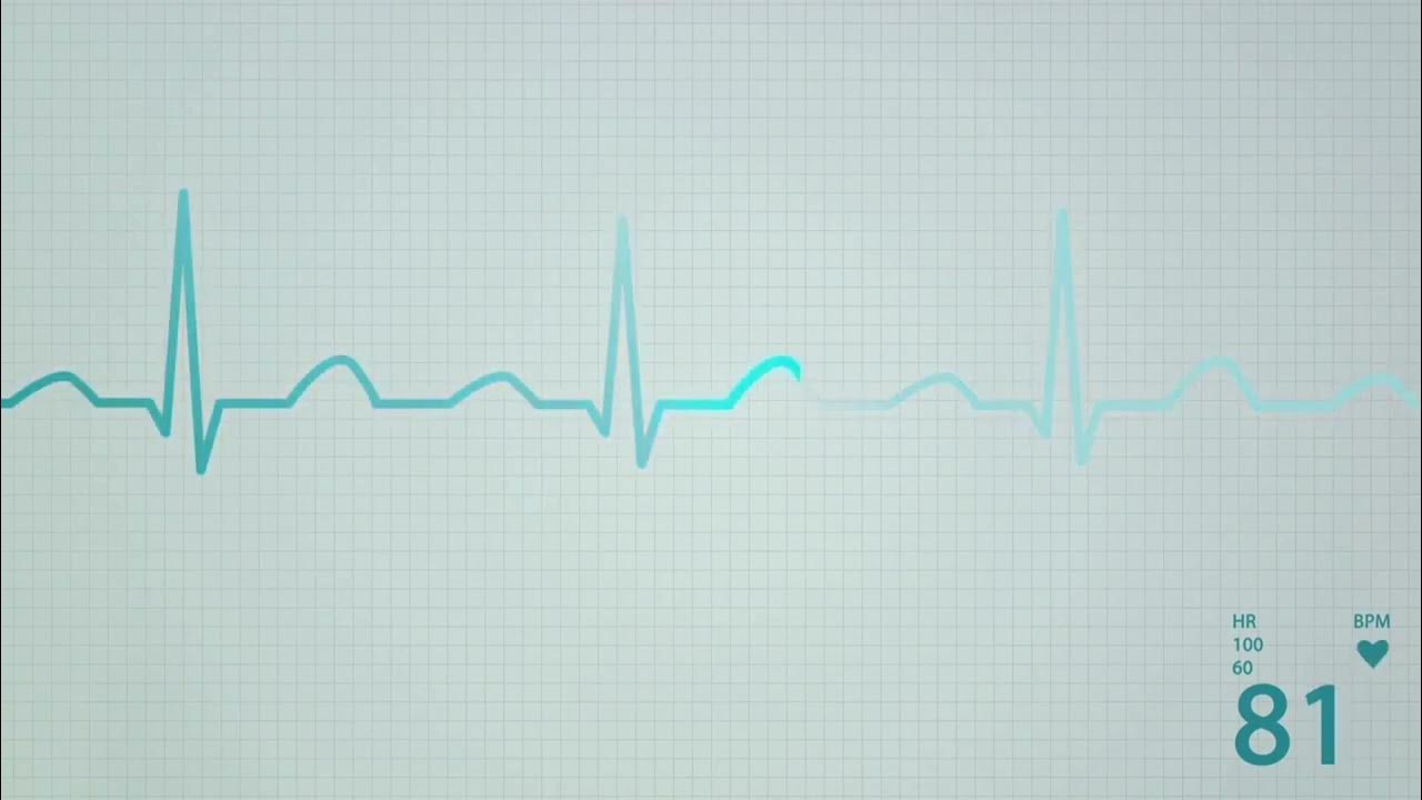 Decode WPW Syndrome: Mastering ECG Delta Waves - YouTube