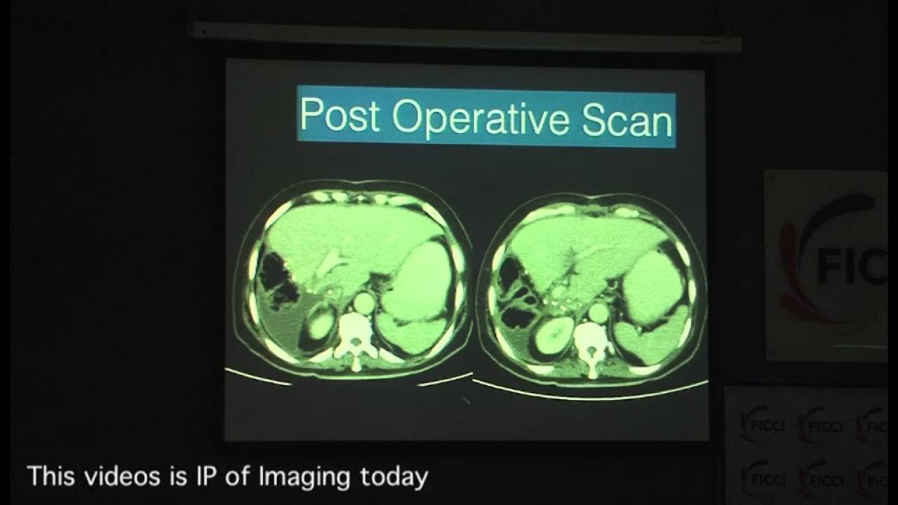 How to plan a hepatic resection? - YouTube