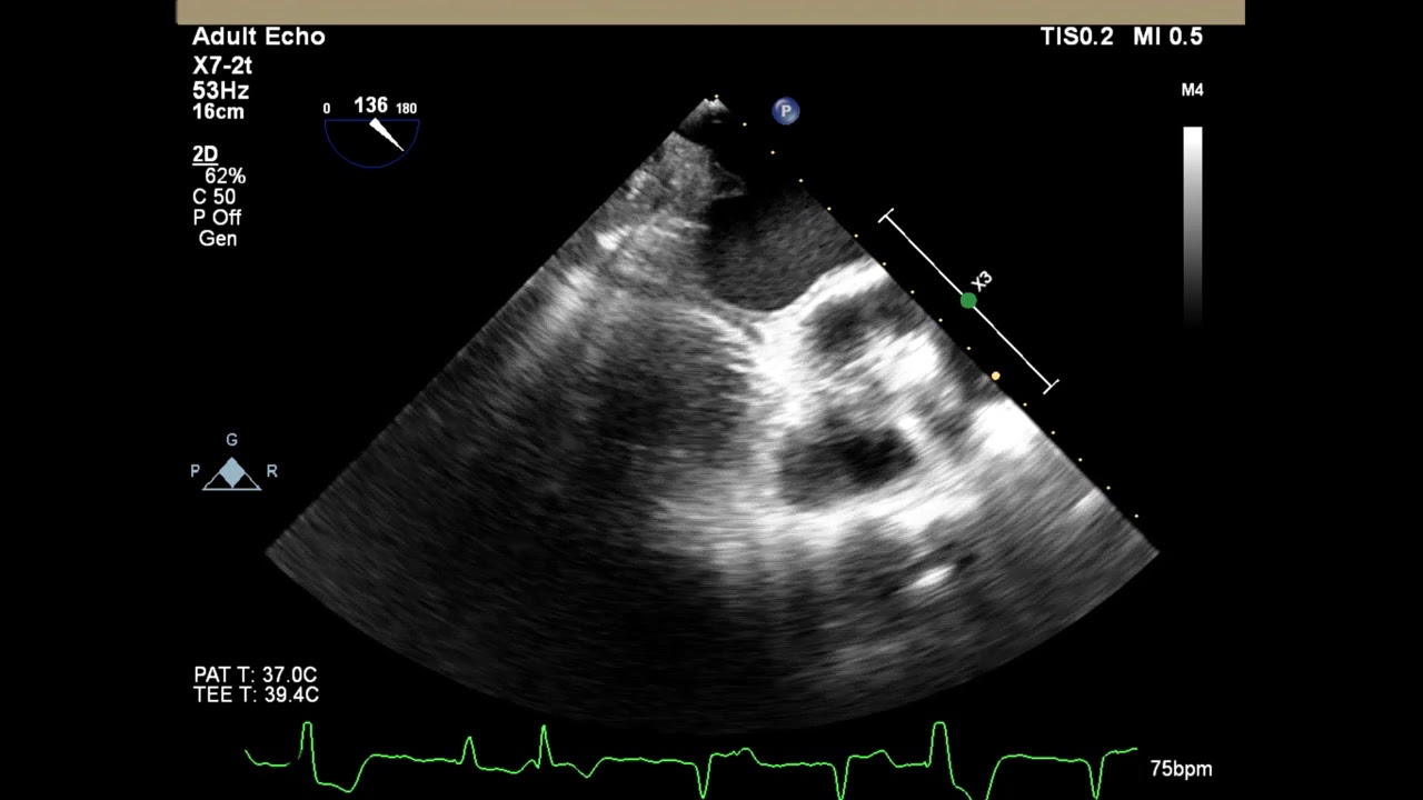 [AP VALVES & SH 2019] Live Case & Lecture 2: TAVR #4 - YouTube