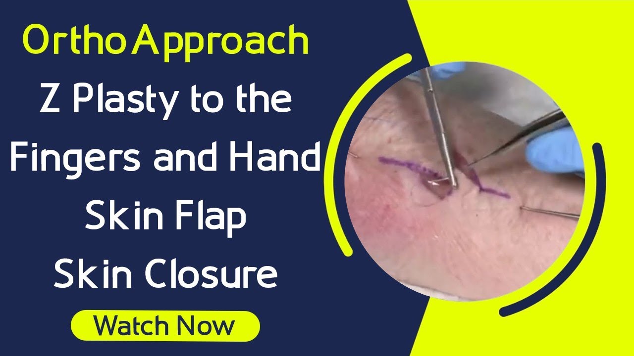 OrthoApproach - Z Plasty to the Fingers and Hand | Skin Flap | Skin ...