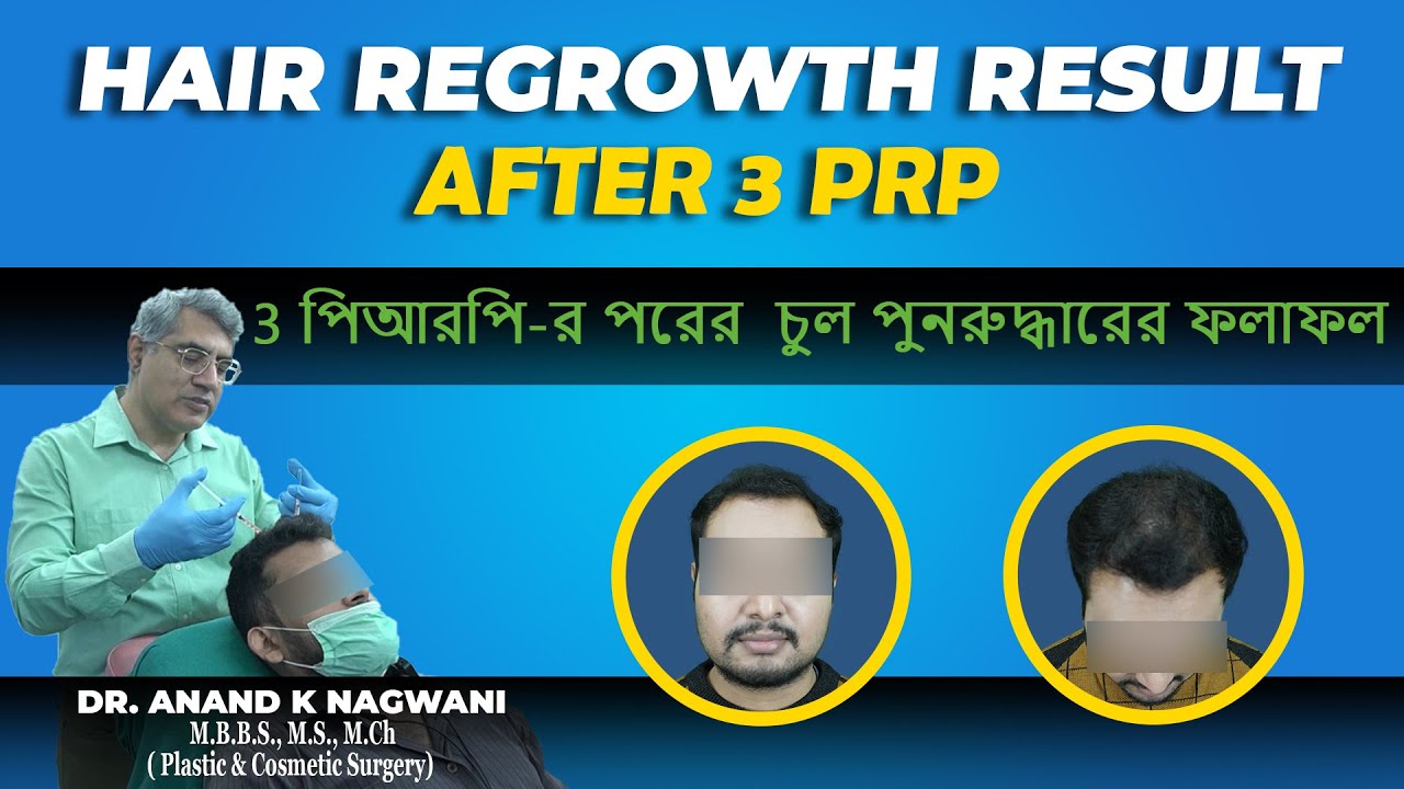 PRP Amazing Results | PRP Therapy for Hair Fall | PRP Tr stop hair fall ...