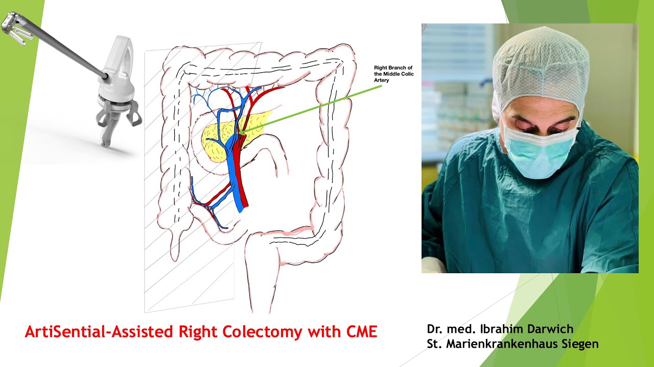Narrated #ArtiSential Right CME Colectomy for Cancer - YouTube