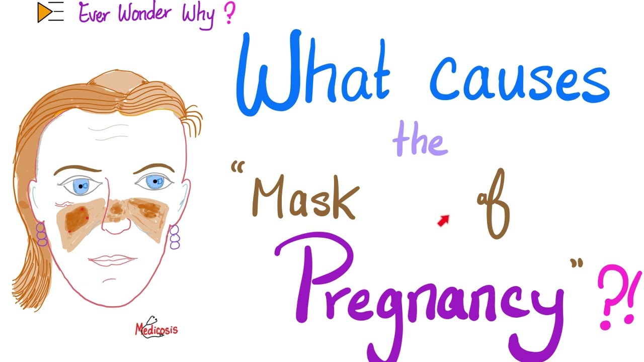 Mask Of Pregnancy