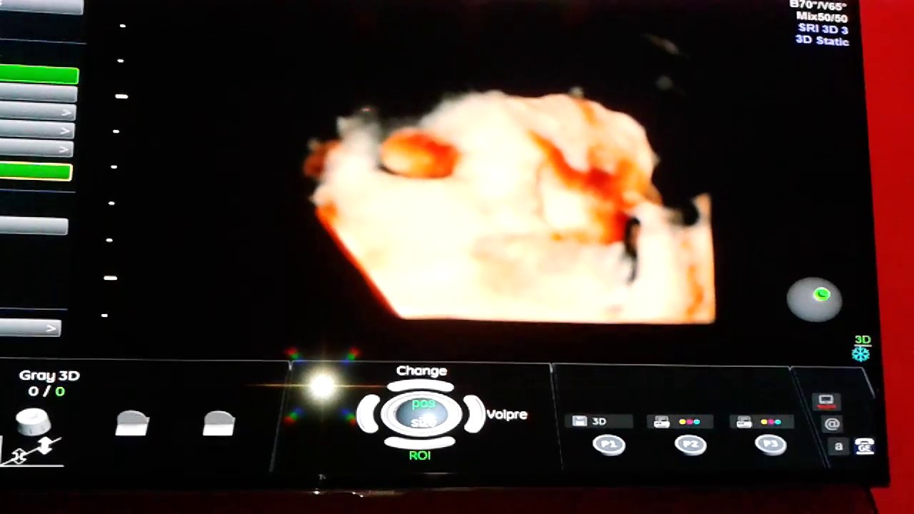 USG 3 Dimensi dokter rizal Jombang - YouTube