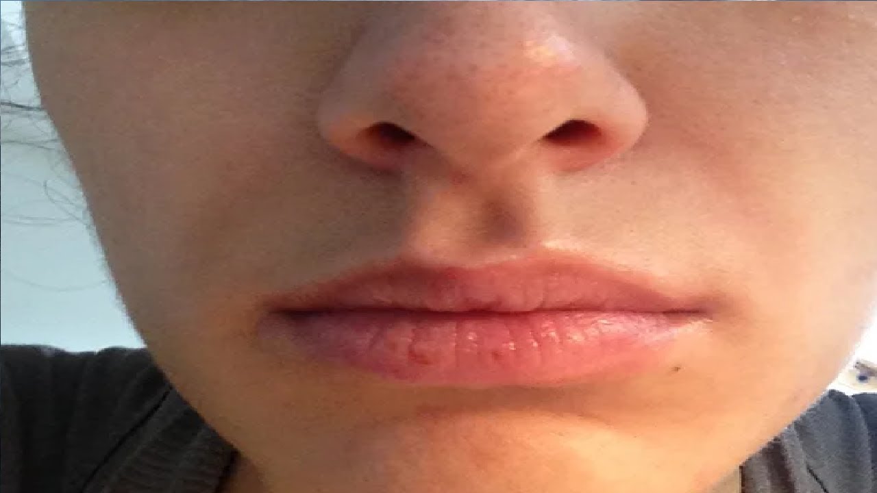 how to get rid of upper lip dark shadow - YouTube