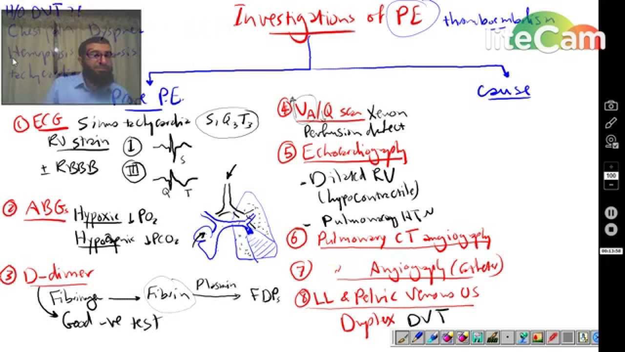 Pulmonary Embolism 1 - Investigations - YouTube