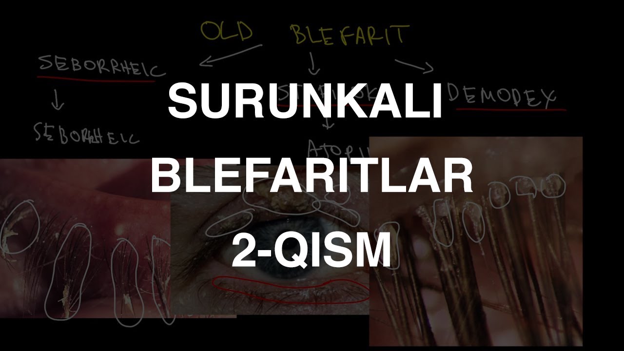 Surunkali blefaritlar | Bek Olimjon - YouTube
