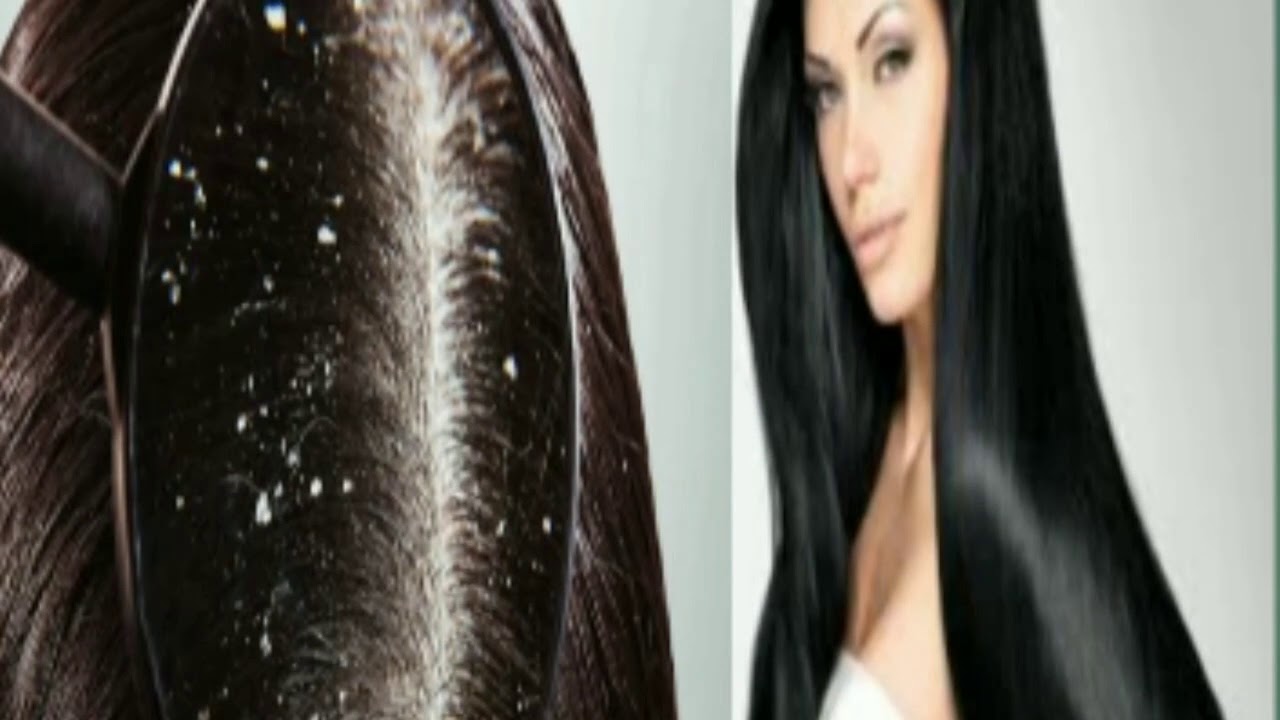 Magical home remidies to remove dandruff at home //how to get rid of ...