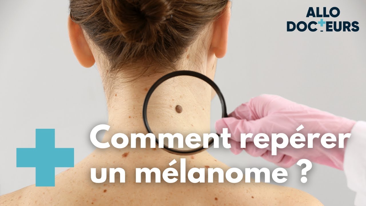 Mélanome : quelle prise en charge ? - Allo Docteurs - YouTube