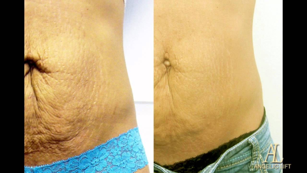 Angelic Mommy Makeover : Post Baby Belly - YouTube