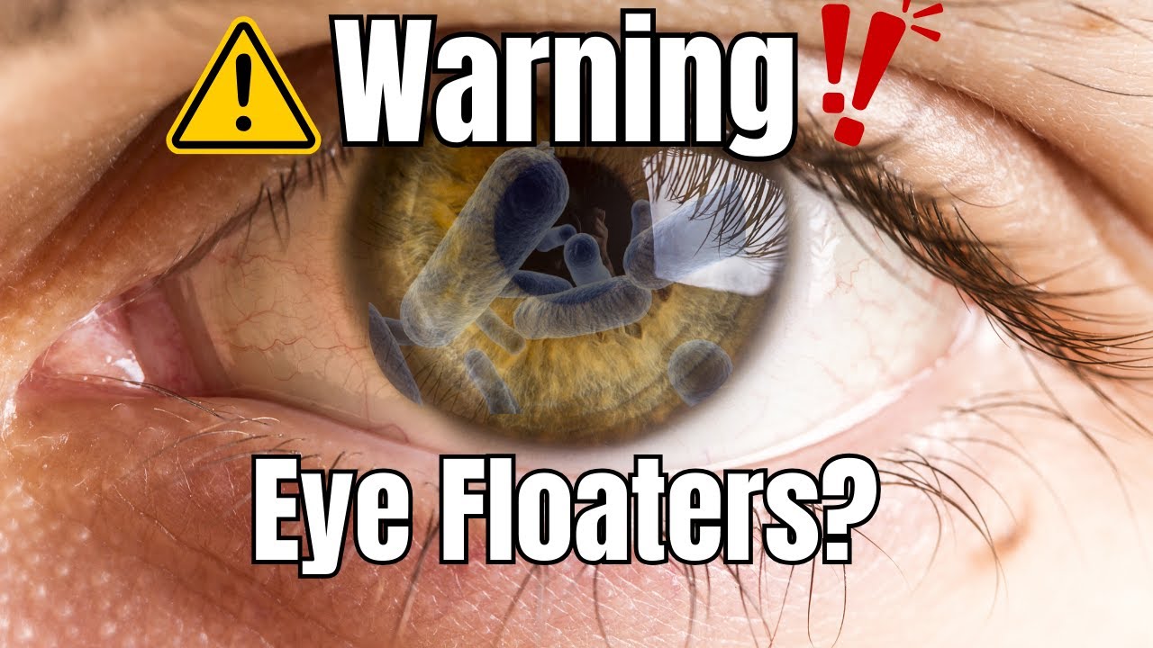 Eye Floaters Simple Explanation - What Are They? - YouTube