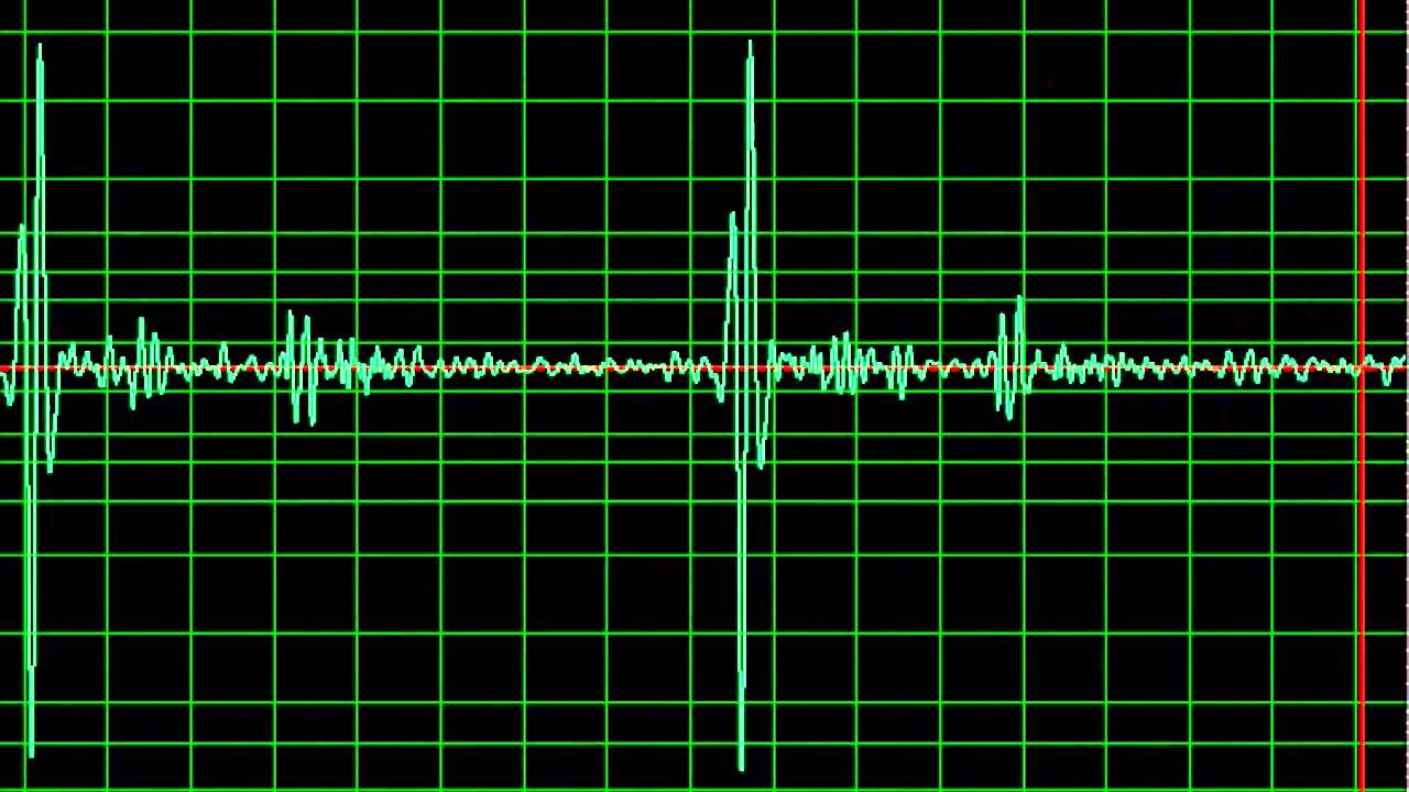 Aortic Regurgitation, Ejection Systolic Murmur- normal speed - YouTube