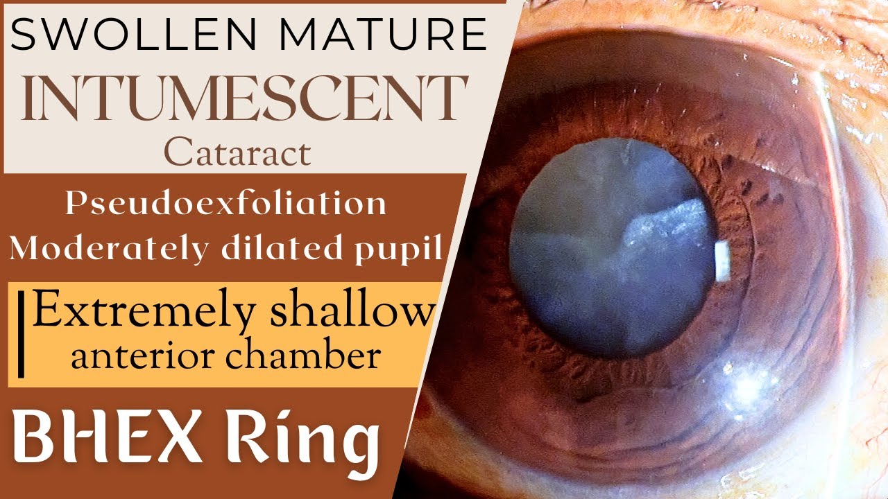 Swollen intumescent cataract with extremely shallow chamber ...