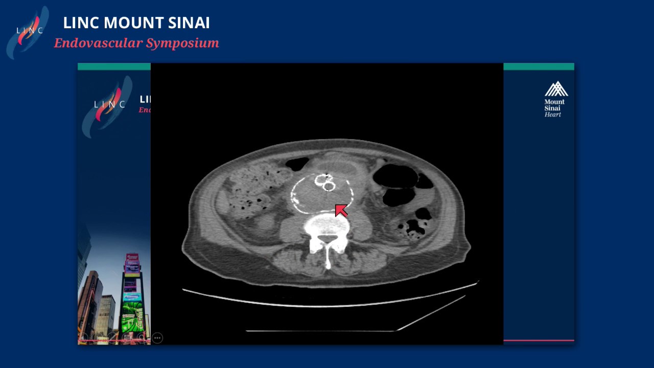 Infected EVAR Grafts: Evaluation and Treatment Options - YouTube