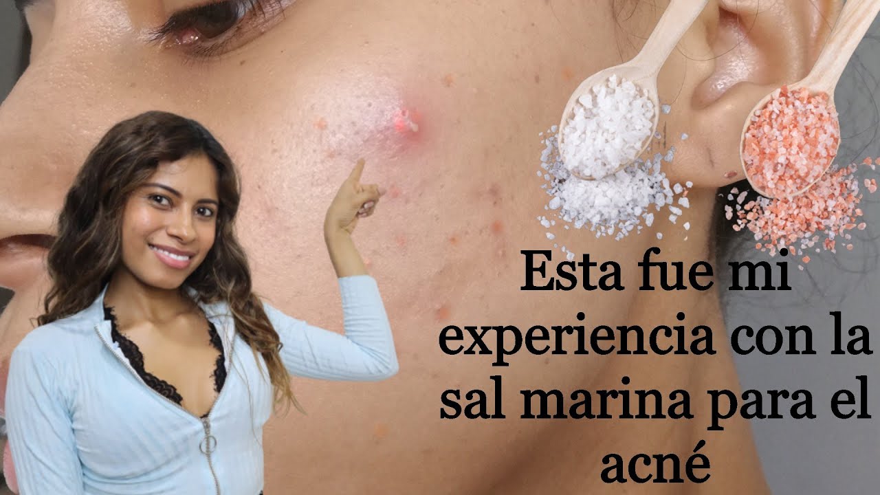 Sal para el acné. si sirve? Mi experiencia!! - YouTube