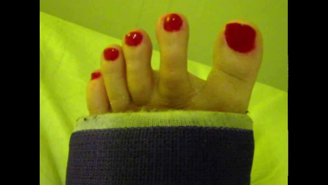 Cherry Red Toenails Wiggle in My Cast - YouTube