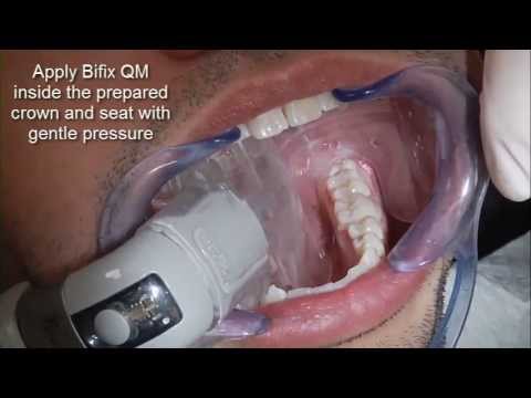 VOCO Bifix QM - the easy clean-up resin cement in a clinical ...