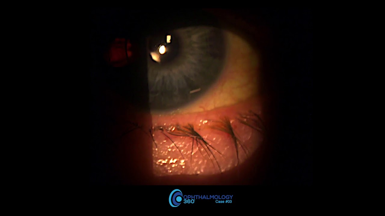 Watch implant of DURYSTA™ for patients with high eye pressure caused by ...
