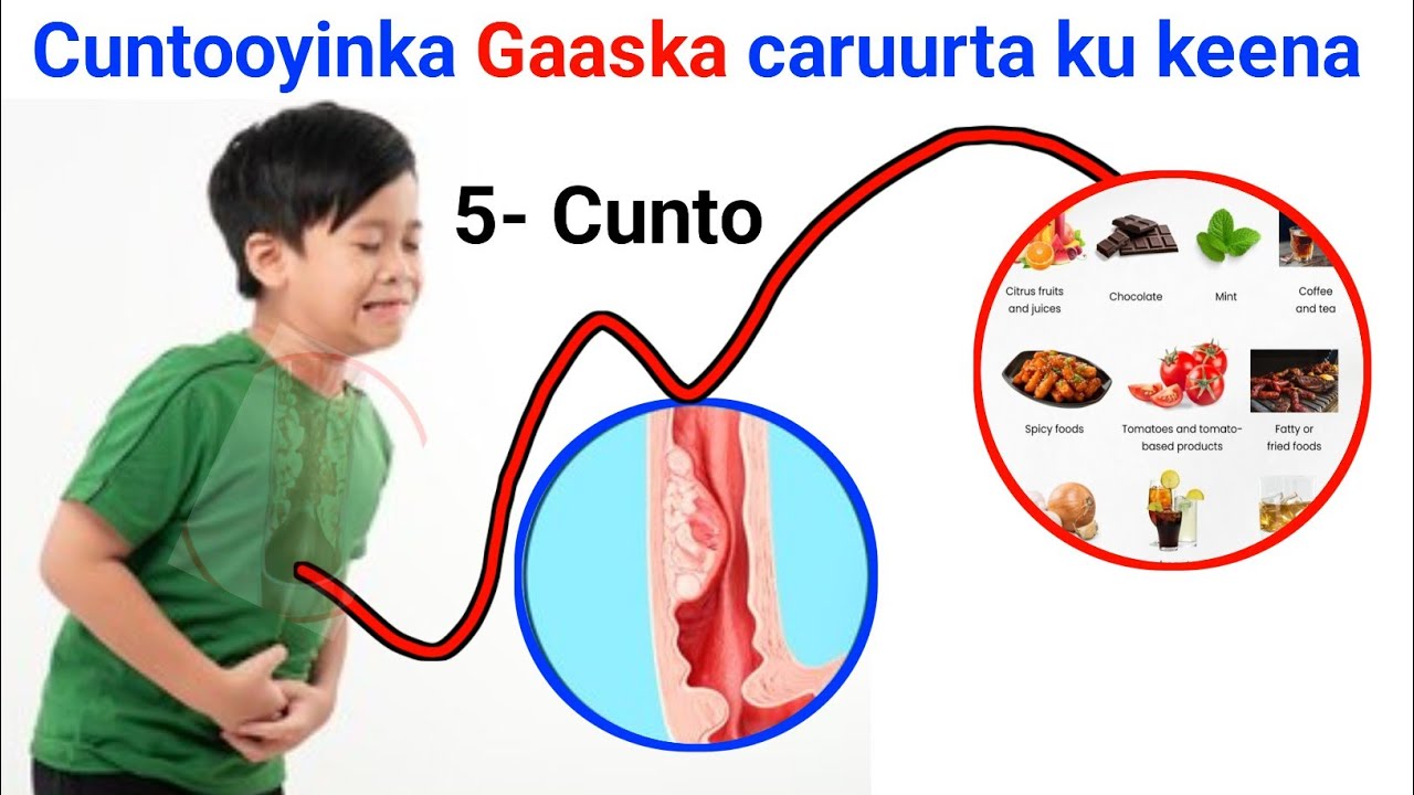 5-taan cunto ka ilaali caruurtaada SI xanuunka Gaaska ugu keenin - YouTube
