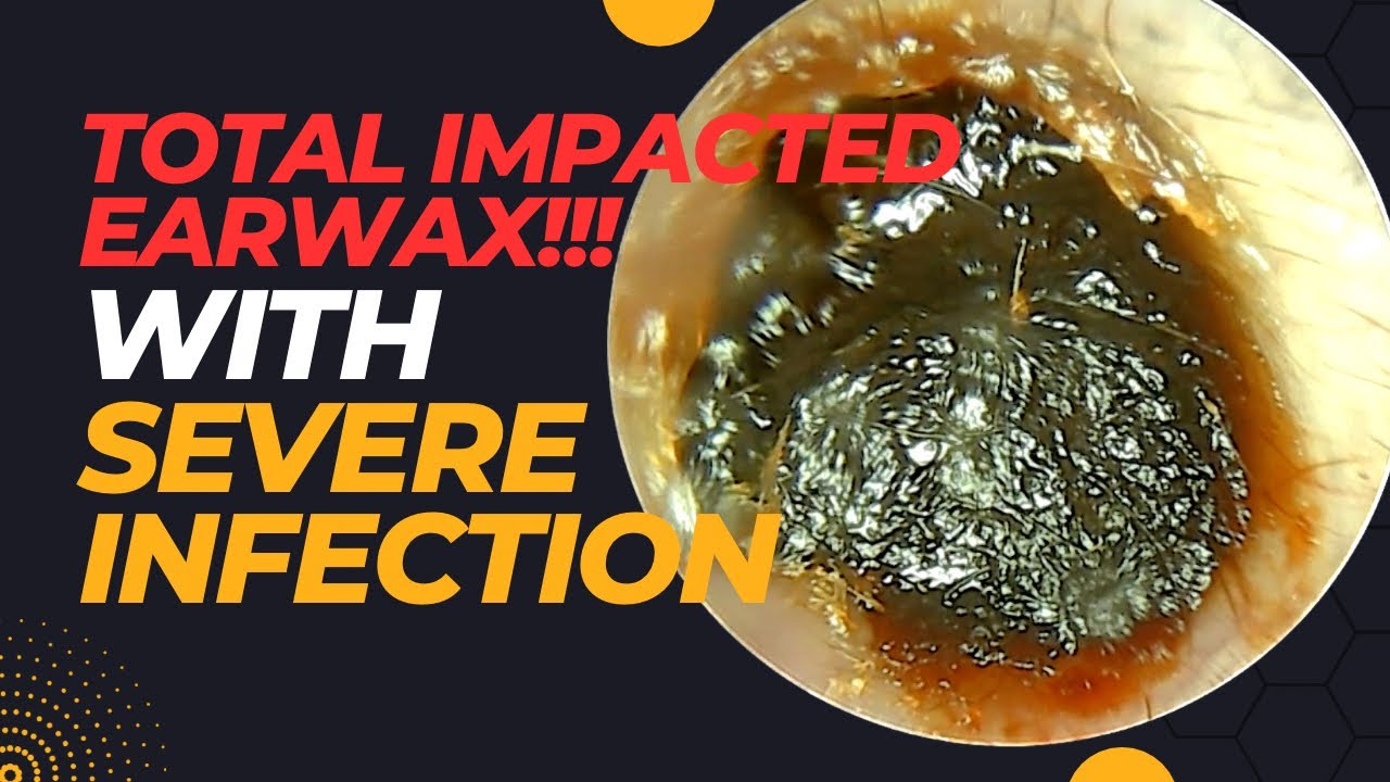 TOTAL Impacted Earwax With SEVERE Infection - YouTube