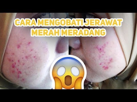 Jerawat Merah Meradang Sembuh! (Honest Review)