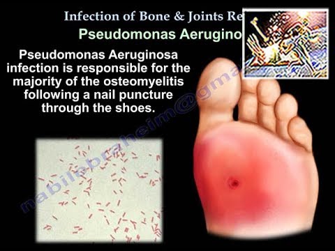 Infection of Bones & Joints, A Review - Everything You Need To Know ...