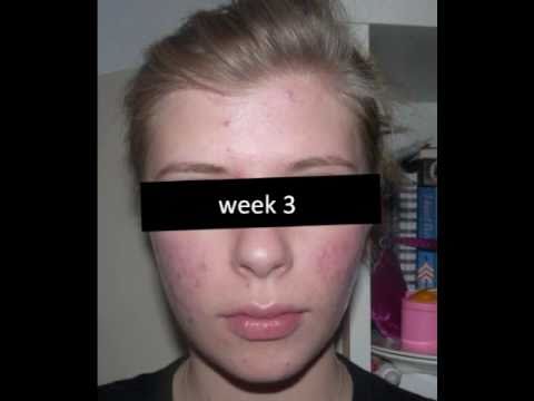 Accutane: Week 5 (Overview) - YouTube