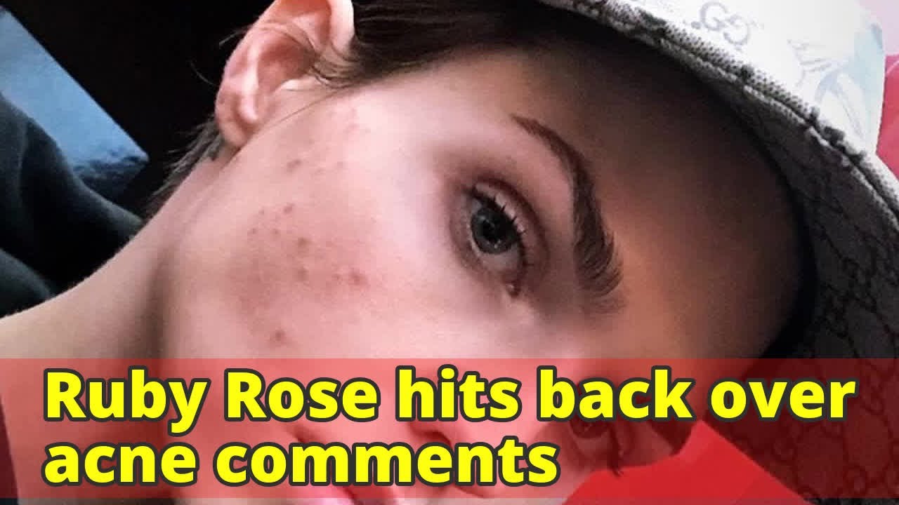 Ruby Rose hits back over acne comments - YouTube