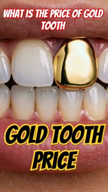 Gold tooth price🦷#status #shorts #dental #dentist #treatment #gold # ...