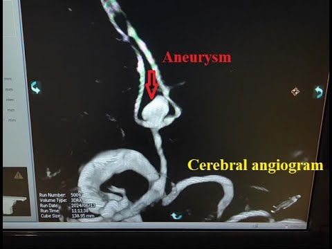ACOM aneurysm clipping - YouTube