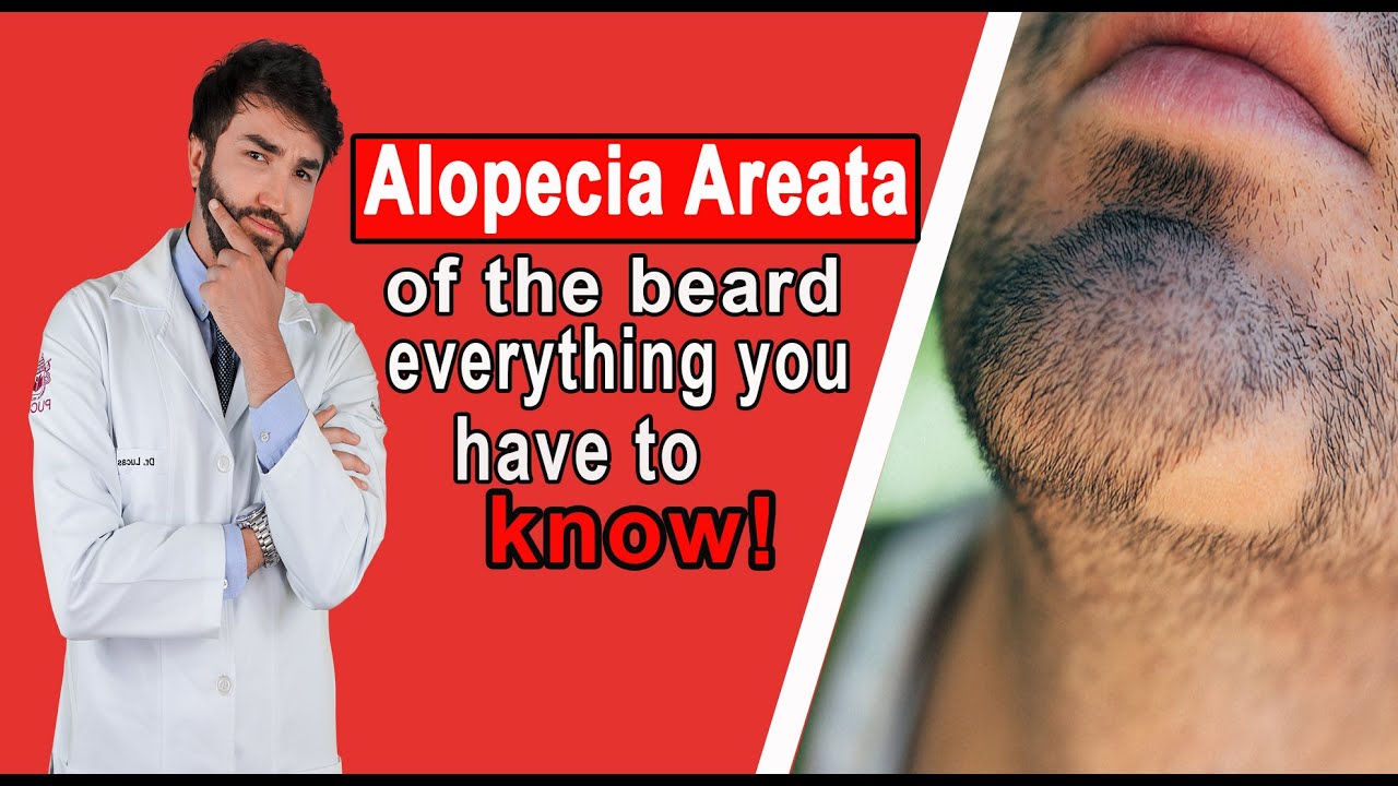 Alopecia Areata of the Beard everything you have to know - YouTube
