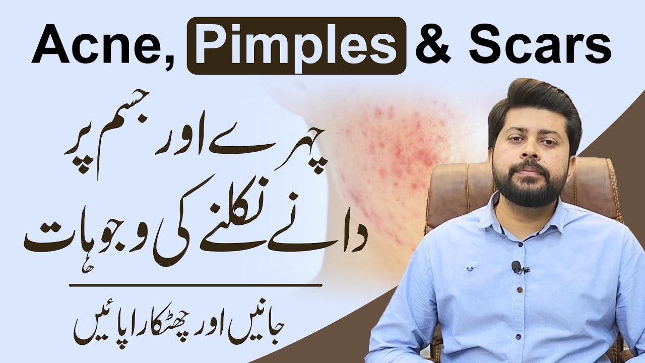 Acne Kyun Hota Hai - Chehre Ke Dano Se Mukamal Nijat - Pimples & Scars ...