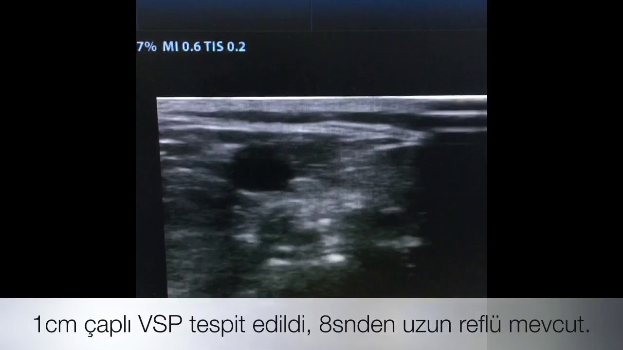 Vena Safena Parva Ligasyonu ve stripingi - YouTube