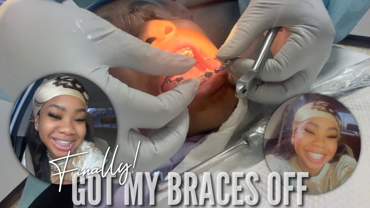 VLOG: GETTING MY BRACES OFF AFTER 4 YEARS *finally* - YouTube