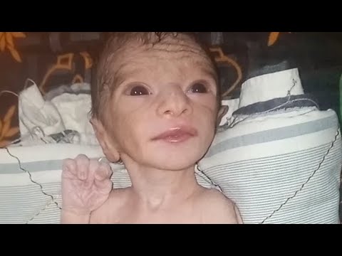 Newborn 7 Month Week Gestation Baby Born After Immediately Birth In ...