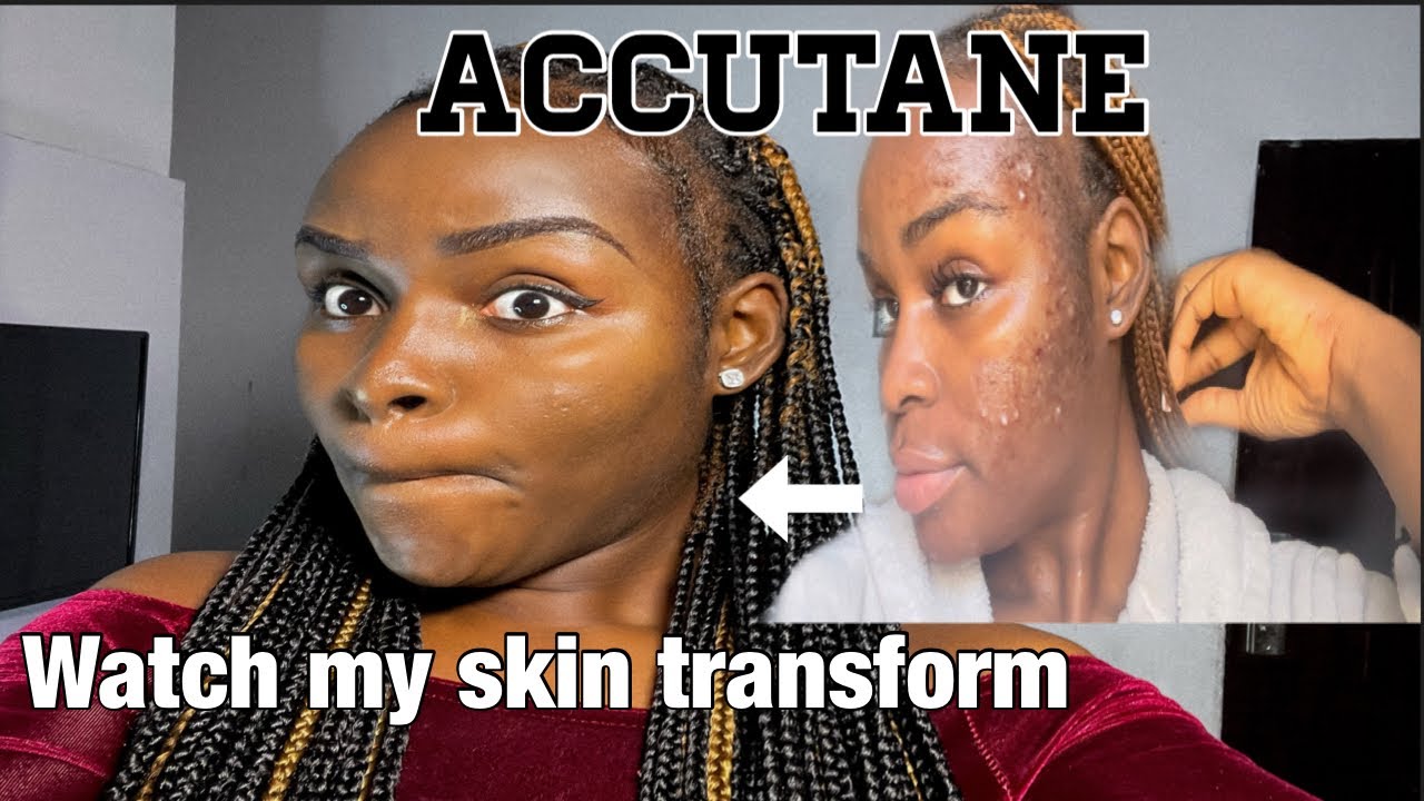 Accutane Review (what 1 Month of Accutane did to my acne prone skin ...