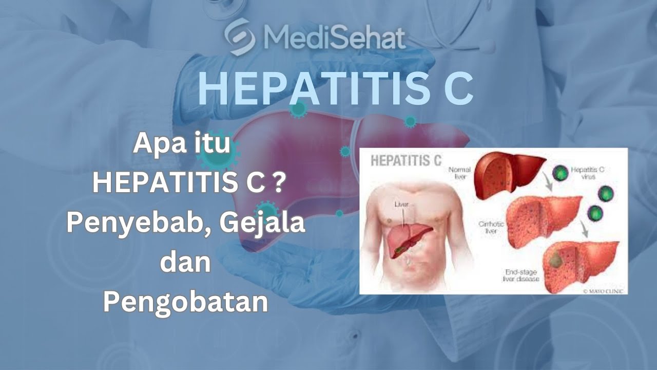 HEPATITIS C - Penyebab, Gejala dan Cara Menangani #berobatkepenang # ...