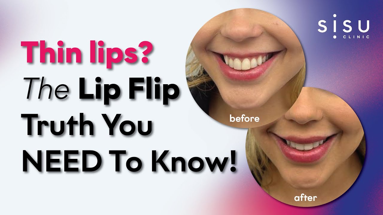 Everything You Need To Know About A Lip Flip - YouTube