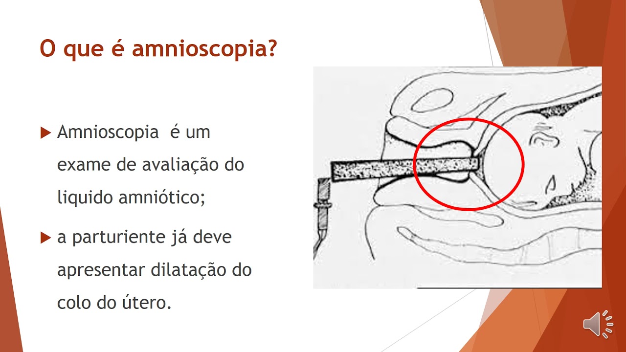 O que é Amniotomia e Amnioscopia. #liquidoamniotico. - YouTube