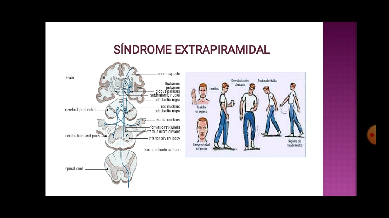 Síndrome Extrapiramidal - YouTube