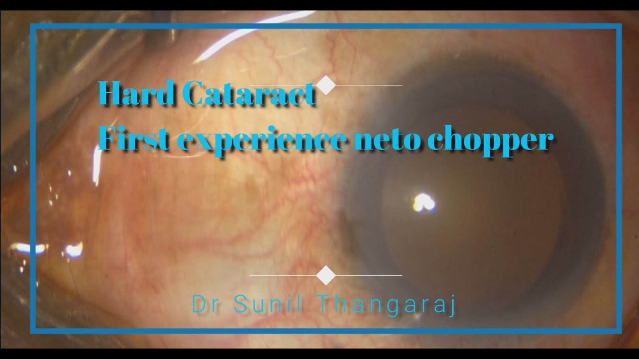 My first case of a relatively hard cataract using the Neto chopper ...