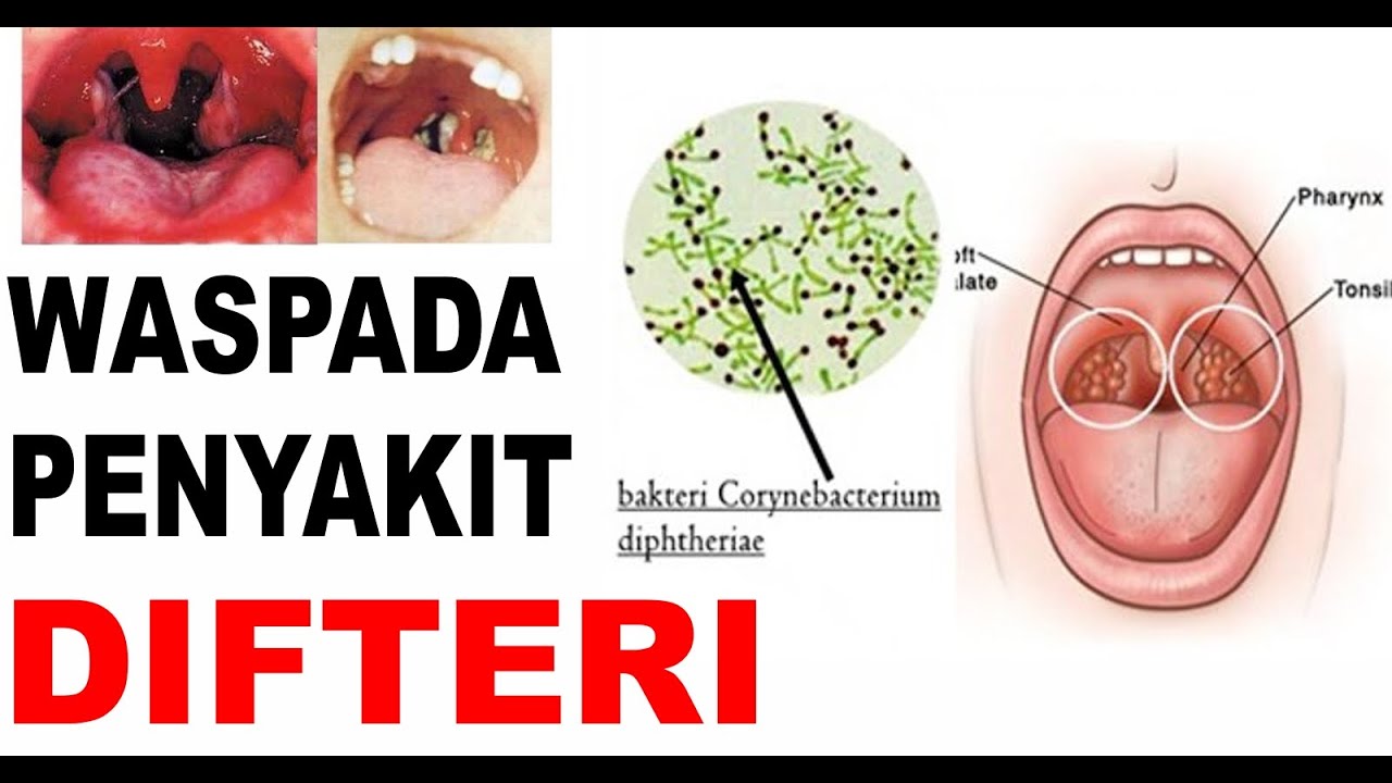 DIFTERI, Definisi, Gejala, Penyebab, Pengobatan, Komplikasi dan ...