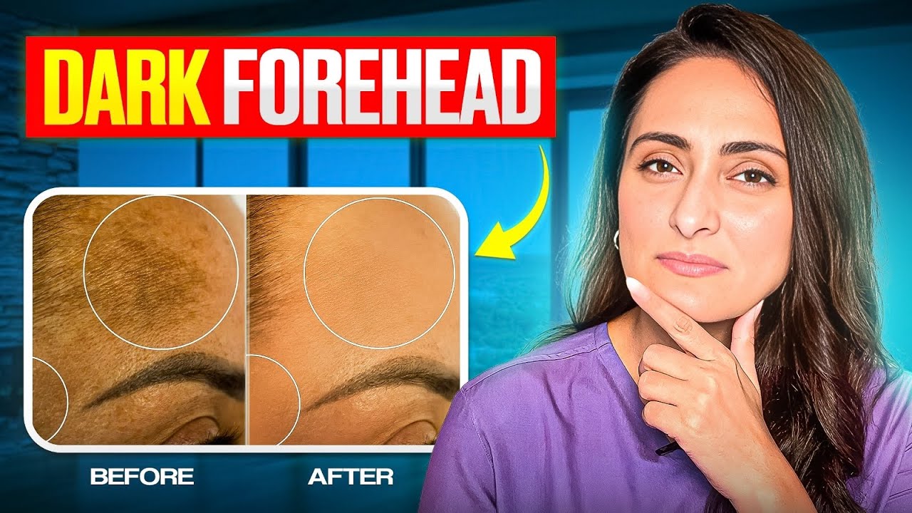 How to treat dark forehead | Causes | Prevention | Dermatologist ...